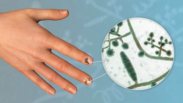 รูปภาพMacroconidia – เลือกดูภาพถ่ายสต็อก เวกเตอร์ และวิดีโอ1,427 ...