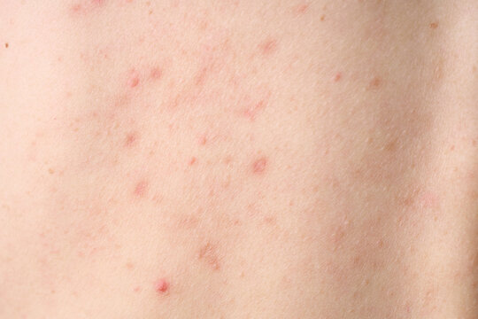 Shingles Rash Images – Browse 2,101 Stock Photos, Vectors, and Video ...