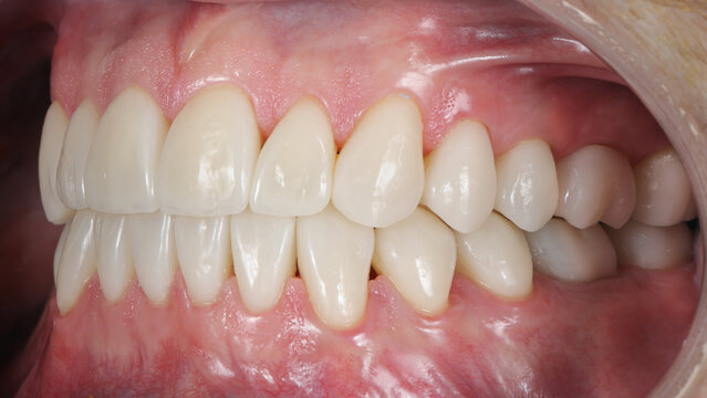 Occlusal Bilder – Durchsuchen 1,047 Archivfotos, Vektorgrafiken und ...