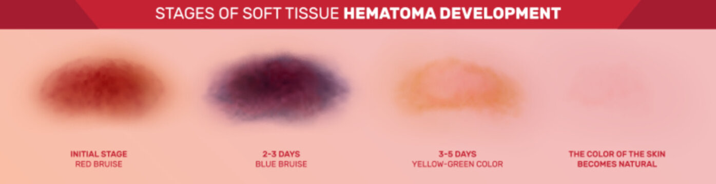 Hematoma Images – Browse 5,881 Stock Photos, Vectors, and Video | Adobe ...