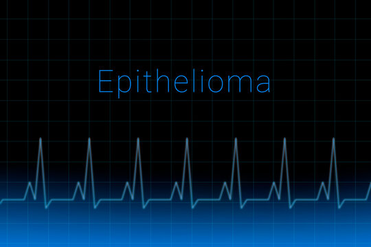 Epithelioma Images – Browse 62 Stock Photos, Vectors, and Video | Adobe ...