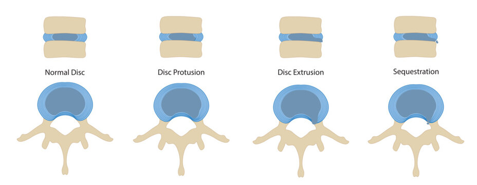 "Intervertebral Disc" Images – Browse 12,264 Stock Photos, Vectors, and ...