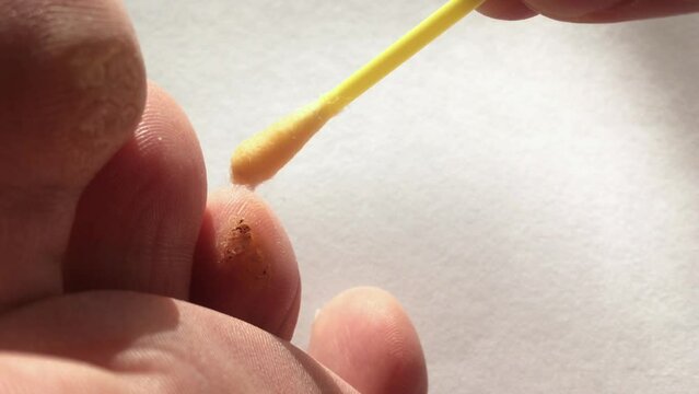 รูปภาพHyperkeratosis – เลือกดูภาพถ่ายสต็อก เวกเตอร์ และวิดีโอ472 ...