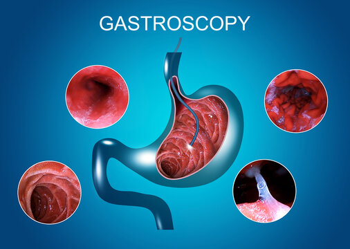 รูปภาพGastroscope – เลือกดูภาพถ่ายสต็อก เวกเตอร์ และวิดีโอ566 | Adobe Stock