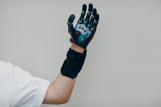 Teilprothese Bilder – Durchsuchen 23,367 Archivfotos, Vektorgrafiken ...