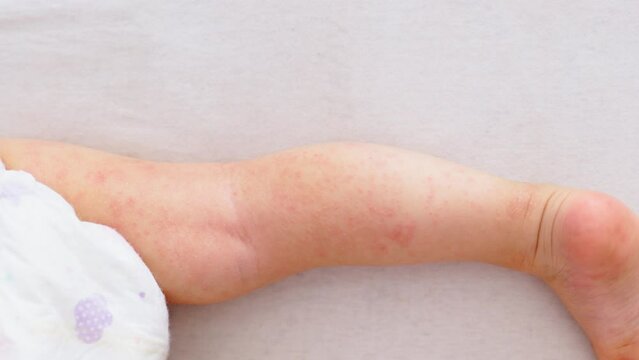Eczema Baby Images – Browse 2,337 Stock Photos, Vectors, and Video ...