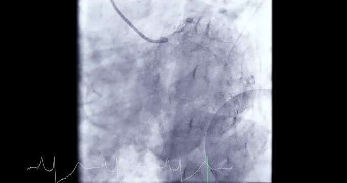 "Coronary Angiogram" Imagens – Procure 574 fotos, vetores e vídeos ...