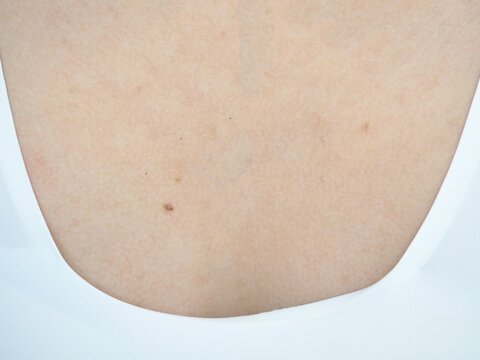 Acrochordons Images – Parcourir 553 le catalogue de photos, vecteurs et ...