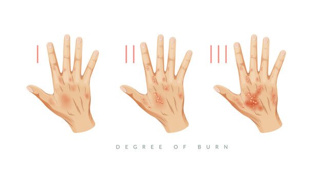 1st Degree Burn Hand