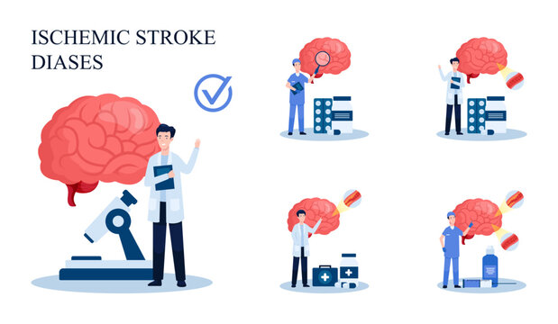 Ischemic Stroke Animation