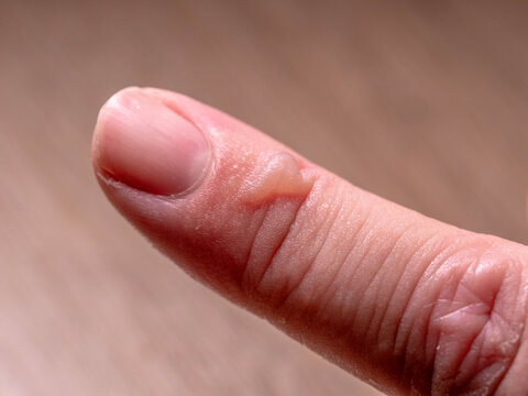 Phlyctène Images – Browse 6 Stock Photos, Vectors, and Video | Adobe Stock