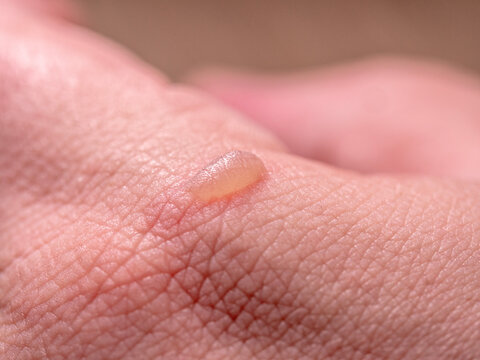 Phlyctène Images – Browse 6 Stock Photos, Vectors, and Video | Adobe Stock