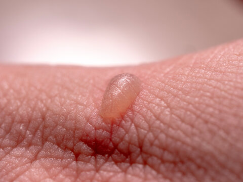 Phlyctène Images – Browse 6 Stock Photos, Vectors, and Video | Adobe Stock