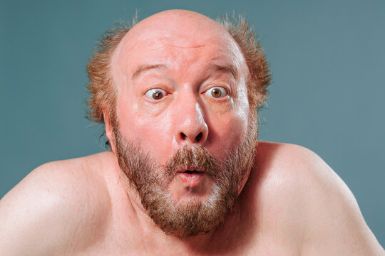 รูปภาพExophthalmia – เลือกดูภาพถ่ายสต็อก เวกเตอร์ และวิดีโอ3,411 ...