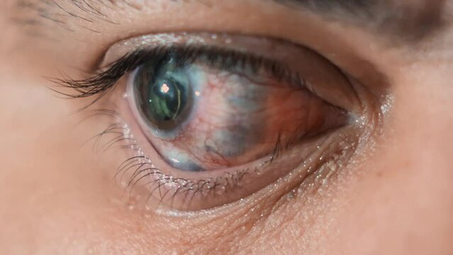 Bindehautsack Bilder – Durchsuchen 1,373 Archivfotos, Vektorgrafiken ...