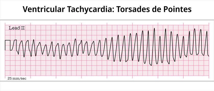 Imágenes de Torsades: descubre bancos de fotos, ilustraciones, vectores ...