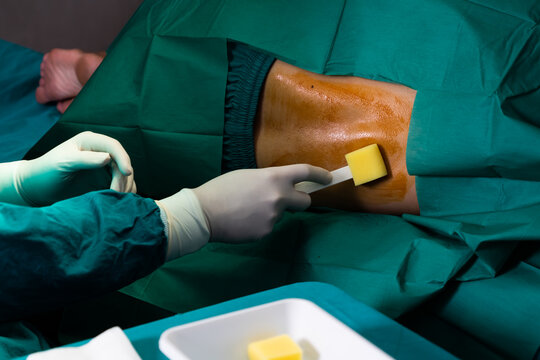 Povidone-Iodine Images – Browse 519 Stock Photos, Vectors, and Video ...