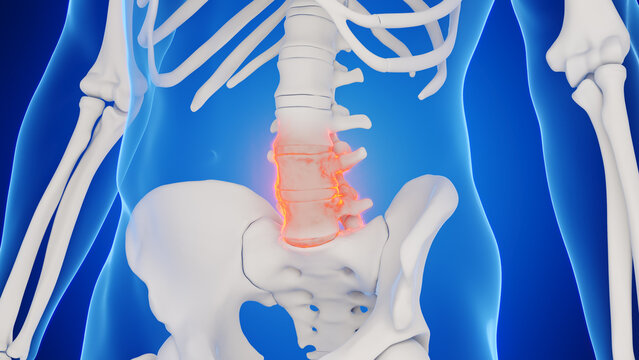 Spondylarthrose-Bilder: Stock-Fotos & -Videos. | Adobe Stock