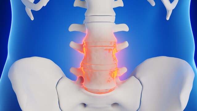 Spondylarthrose Bilder – Durchsuchen 463 Archivfotos, Vektorgrafiken ...