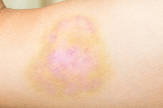 Blue(Bruise) 이미지 – 찾아보기 3,632 스톡 사진, 벡터 및 비디오 | Adobe Stock