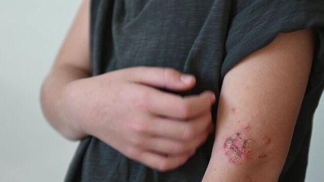 รูปภาพLesions – เลือกดูภาพถ่ายสต็อก เวกเตอร์ และวิดีโอ16,972 | Adobe Stock