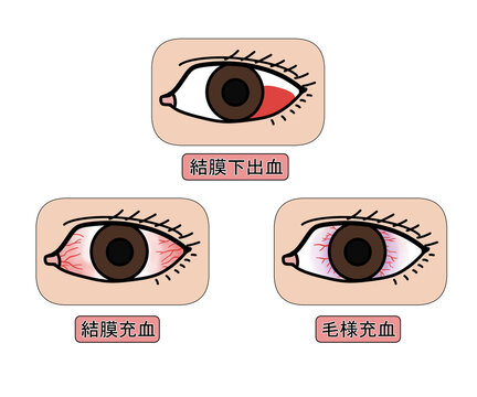 Bindehautsack Bilder – Durchsuchen 1,531 Archivfotos, Vektorgrafiken ...