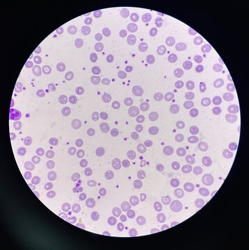 Plasmocyte bilder – Bläddra bland 601 stockfoton, vektorer och videor ...