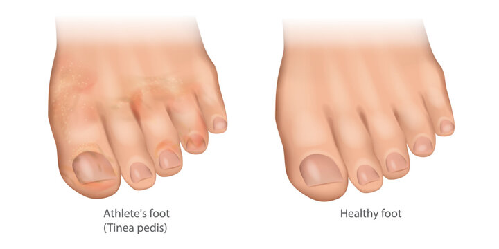 รูปภาพDermatophytosis – เลือกดูภาพถ่ายสต็อก เวกเตอร์ และวิดีโอ8,199 ...