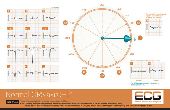 Qrs-Komplex Bilder – Durchsuchen 411 Archivfotos, Vektorgrafiken und ...
