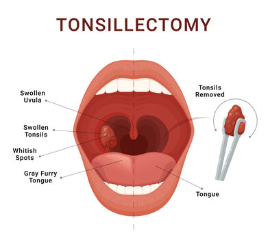 Tonsil Removal