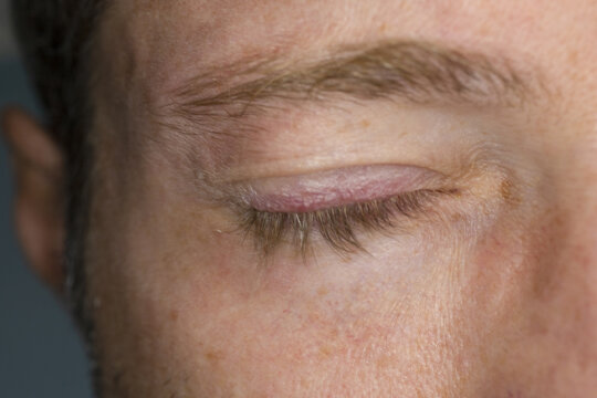 Blefarit bilder – Bläddra bland 1,184 stockfoton, vektorer och videor ...