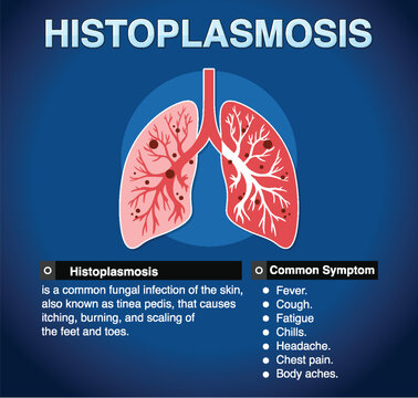 Histoplasmosis Skin