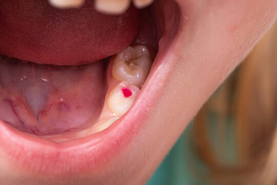 "Deep Caries" Images – Browse 52 Stock Photos, Vectors, and Video ...