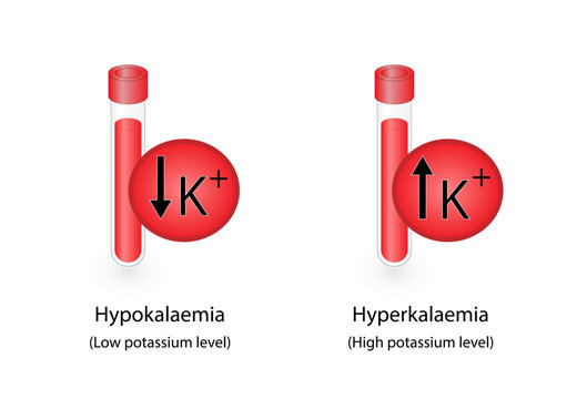 Hypokalemia Disease