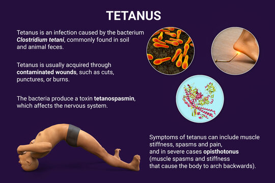 「Opisthotonos」の写真素材 | 25件の無料イラスト画像 | Adobe Stock
