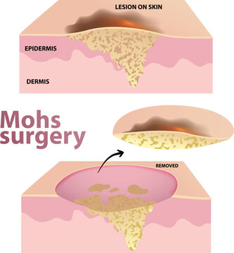 Basaliom-Bilder: Stock-Fotos & -Videos. | Adobe Stock