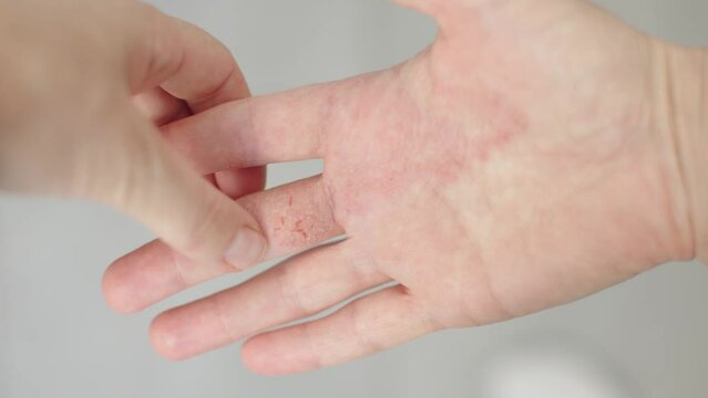 Neurodermatitis Images – Parcourir 516 le catalogue de photos, vecteurs ...