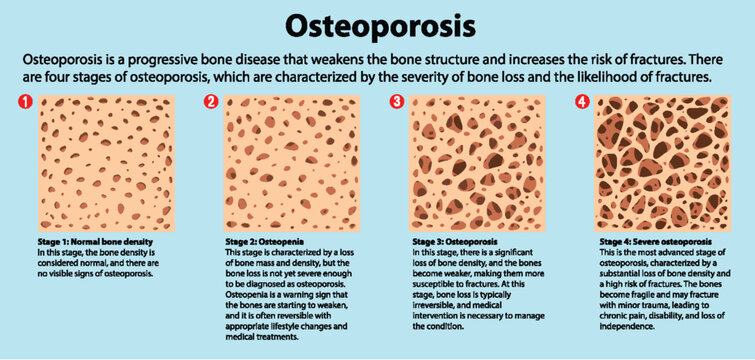 Osteopenia Vs Normal