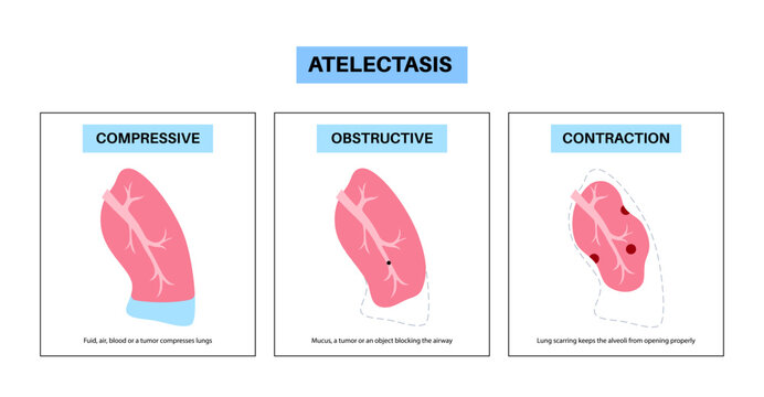 Atelectasis Alveoli