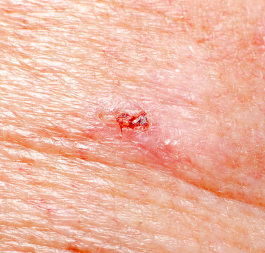 Basaliom Bilder – Durchsuchen 356 Archivfotos, Vektorgrafiken und ...