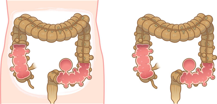 "Sigmoid Flexure" Bilder – Durchsuchen 583 Archivfotos, Vektorgrafiken ...