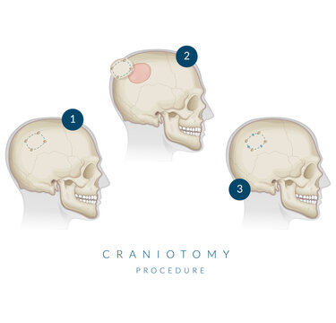 Craniotomy Bilder – Durchsuchen 391 Archivfotos, Vektorgrafiken und ...