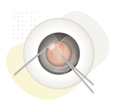 Phaco Bilder – Durchsuchen 329 Archivfotos, Vektorgrafiken und Videos | Adobe Stock
