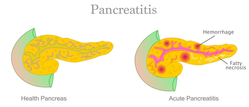 Chronic Pancreatitis Images – Browse 1,343 Stock Photos, Vectors, and ...