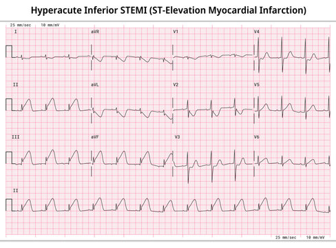 Inferior Stemi