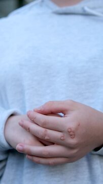 "Hpv Virus" Images – Browse 260 Stock Photos, Vectors, and Video ...