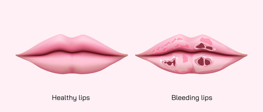 Cracked Lips Clip Art
