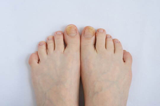 "Zehen Bilder – Durchsuchen 218,145 Archivfotos, Vektorgrafiken und ...