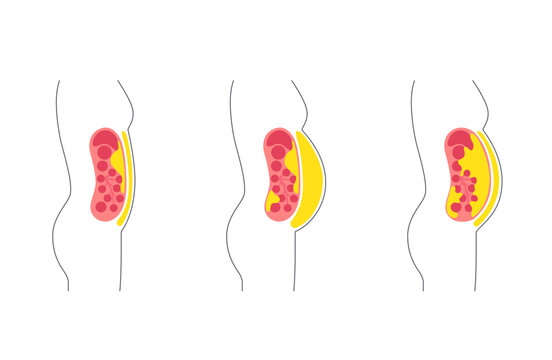 Viszeralfett Bilder – Durchsuchen 797 Archivfotos, Vektorgrafiken und ...