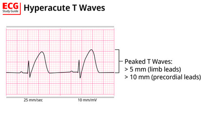 Plakat Set of ECG Common Abnormalities - Bigeminy vs Trigeminy ...